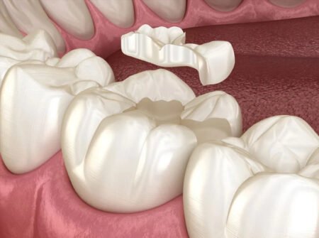 Dental Bonded Fillings in St. Albert | Bonded Fillings Near You